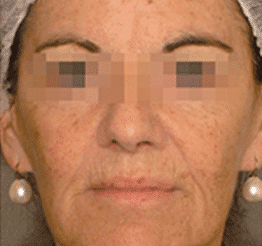 Accent Prime | Body & Face Contouring Machine | Alma