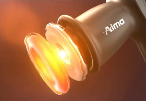 UltraWave Technology | Alma
