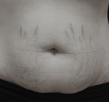 Stretch Marks (Striae) Treatments | Alma